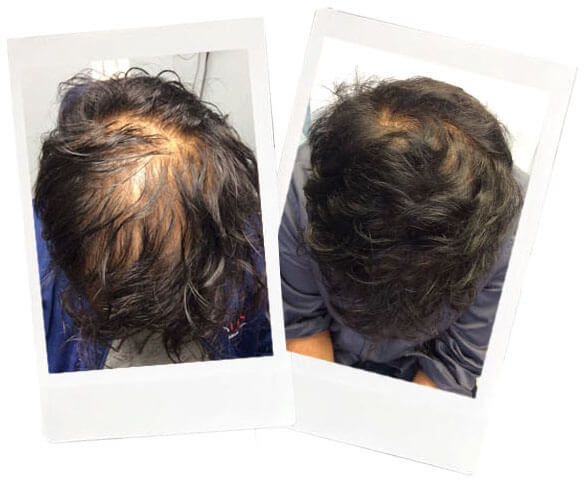 Happy Head Reviews: Topical Finasteride Advantage